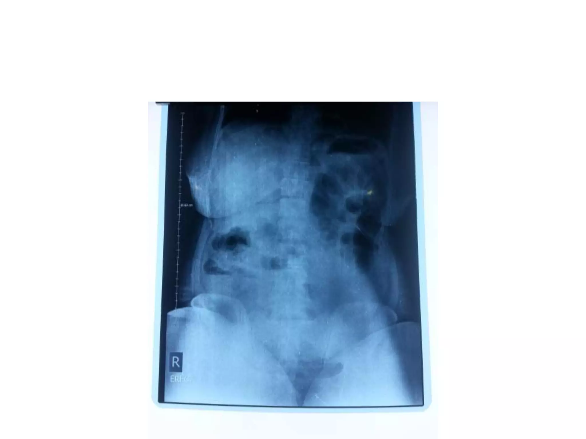 Diffuse peritonitis | PPTX