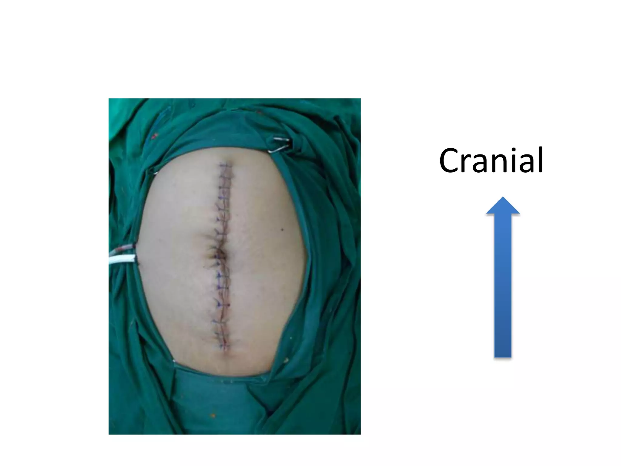 Diffuse peritonitis | PPTX