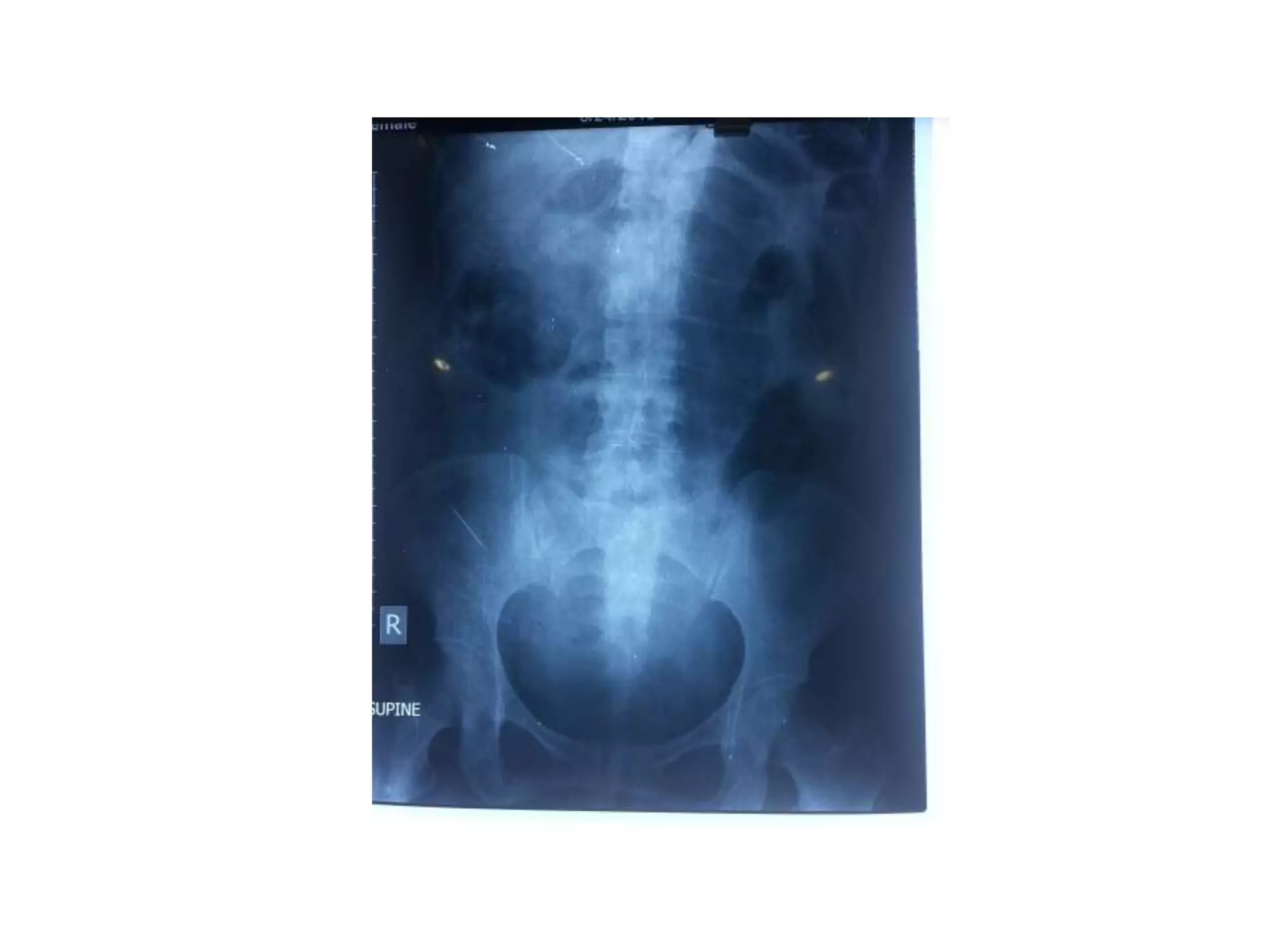 Diffuse Peritonitis Pptx