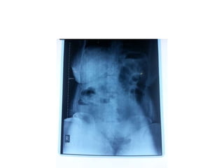 Diffuse peritonitis | PPTX