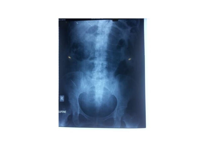 Diffuse peritonitis | PPT