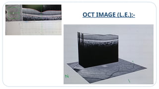 Diffuse Unilateral Sub-acute Neuroretinitis.pptx