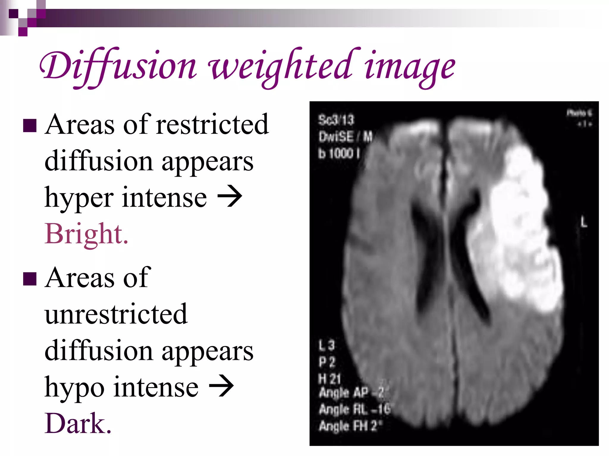 DIFFUSION & PERFUSION r MRI.ppt