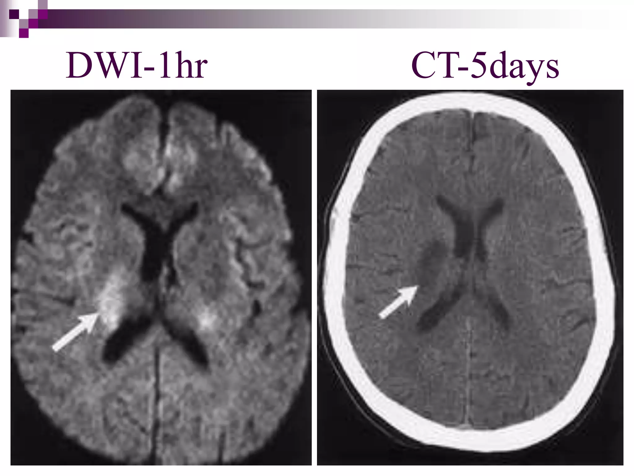 DIFFUSION & PERFUSION r MRI.ppt