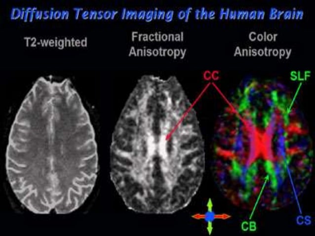 DIFFUSION & PERFUSION r MRI.ppt