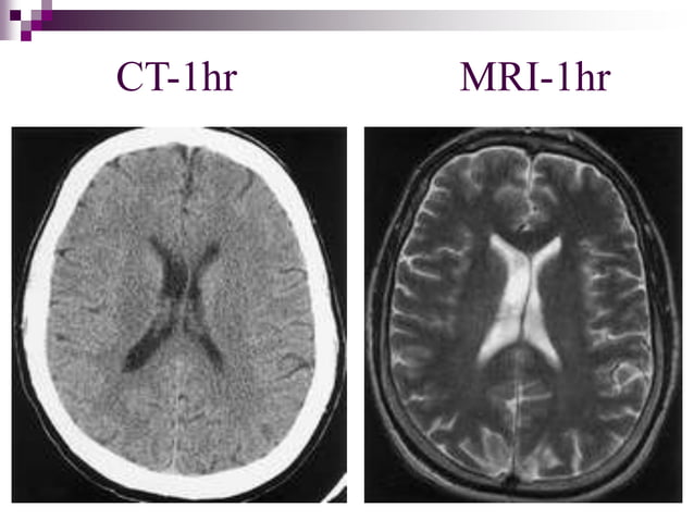 DIFFUSION & PERFUSION r MRI.ppt