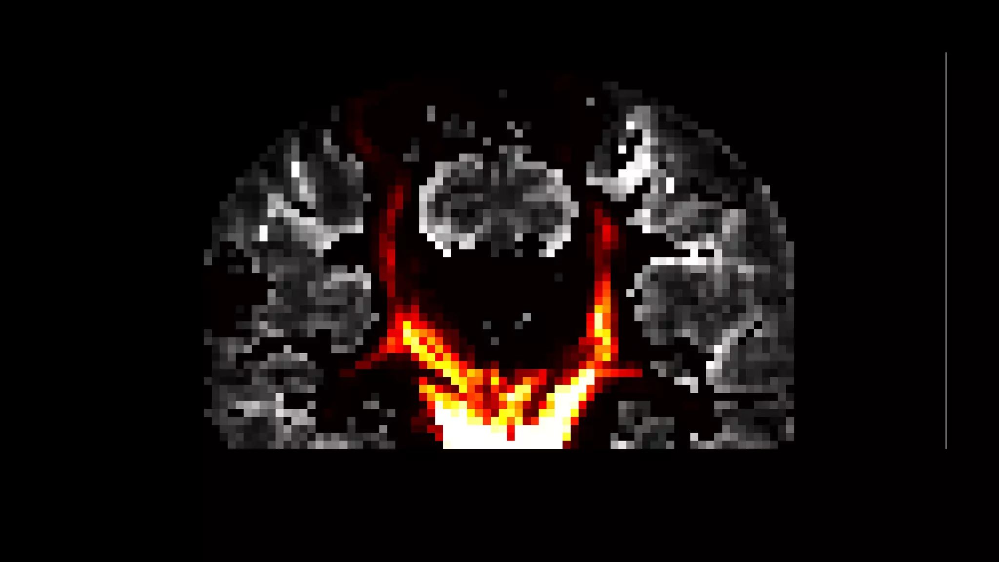 Diffusion tensor imaging in Neurology | PPTX