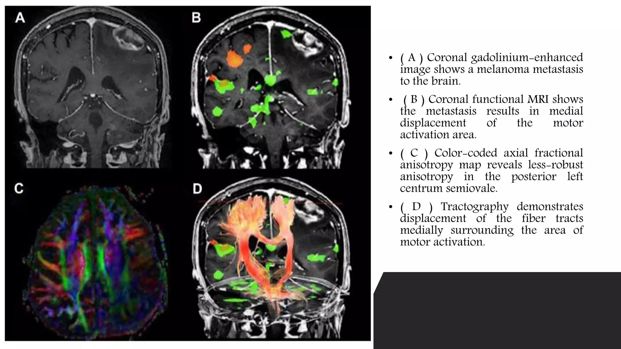 Diffusion tensor imaging in Neurology | PPTX