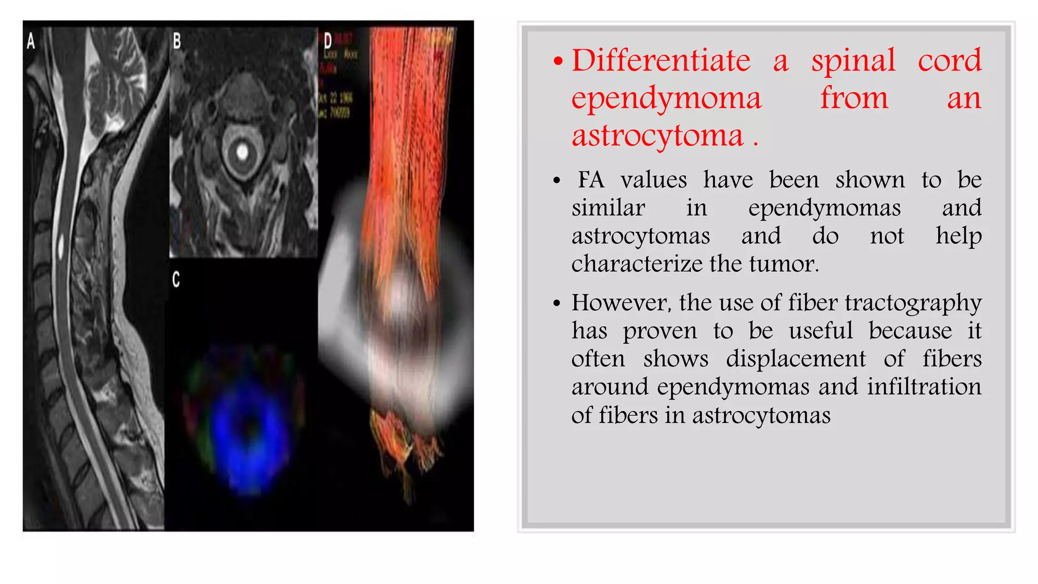 Diffusion tensor imaging in Neurology | PPTX