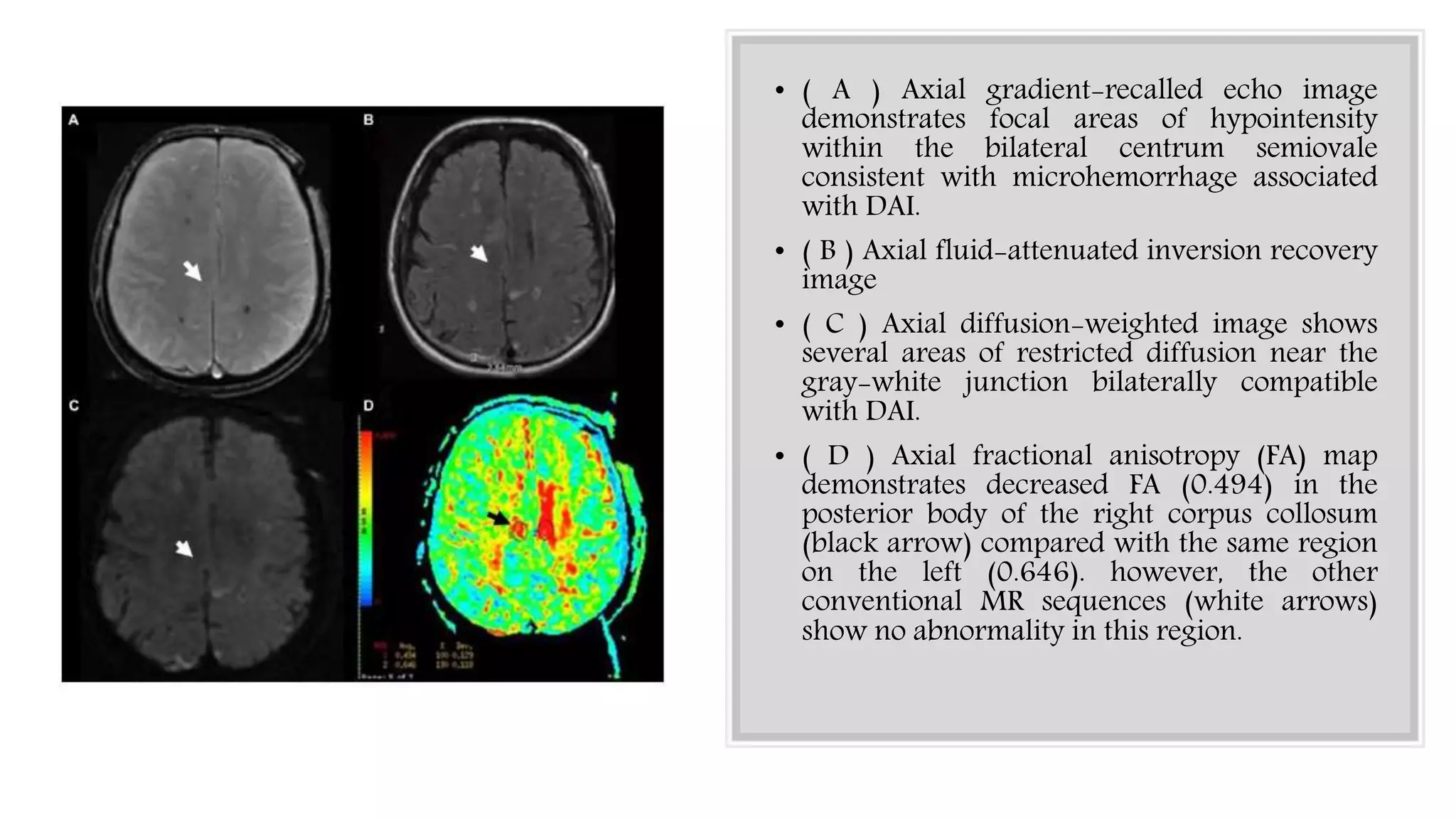 Diffusion tensor imaging in Neurology | PPTX