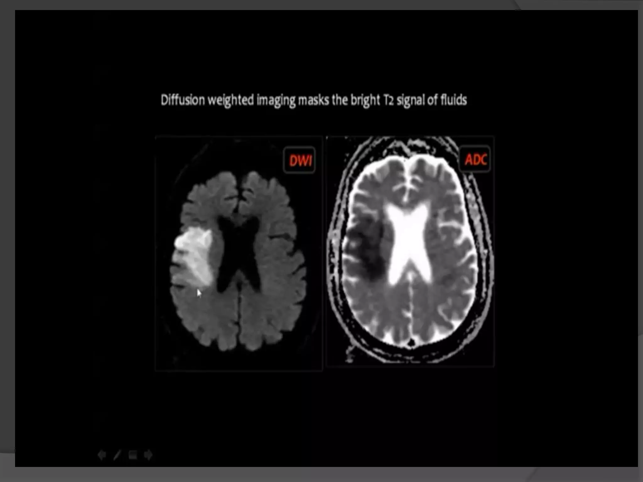 Diffusion weighted brain imaging | PPT
