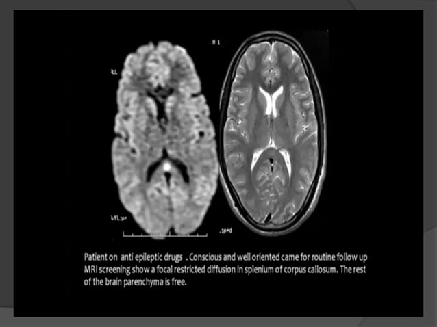 Diffusion weighted brain imaging | PPTX