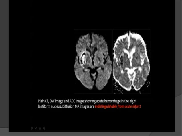 Diffusion weighted brain imaging | PPT