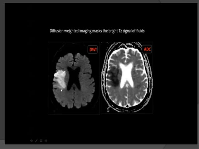 Diffusion weighted brain imaging | PPT