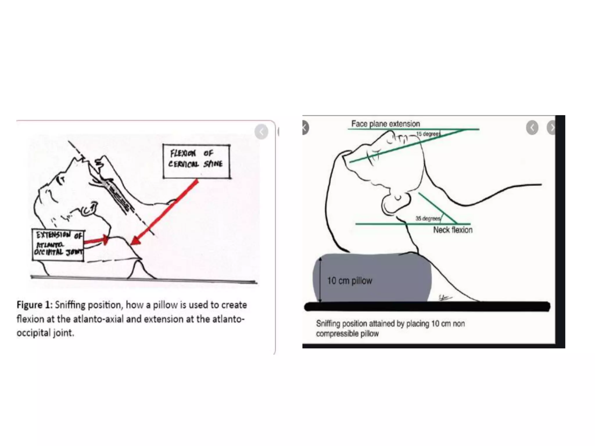 Dificult airway management in icu | PPTX