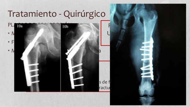Fracturas de Diáfisis femoral