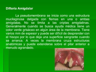 Difteria | PPT