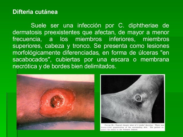 Difteria