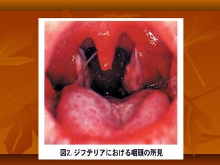 Difteria | PPT