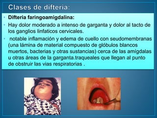 Difteria desde el punto de vista epidemiologico | PPTX