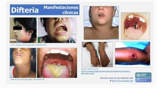 Enfermedad por Difteria_signos, sintomas y dx.pptx