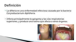 Enfermedad por Difteria_signos, sintomas y dx.pptx