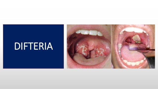 Difteria, Tos Ferina.