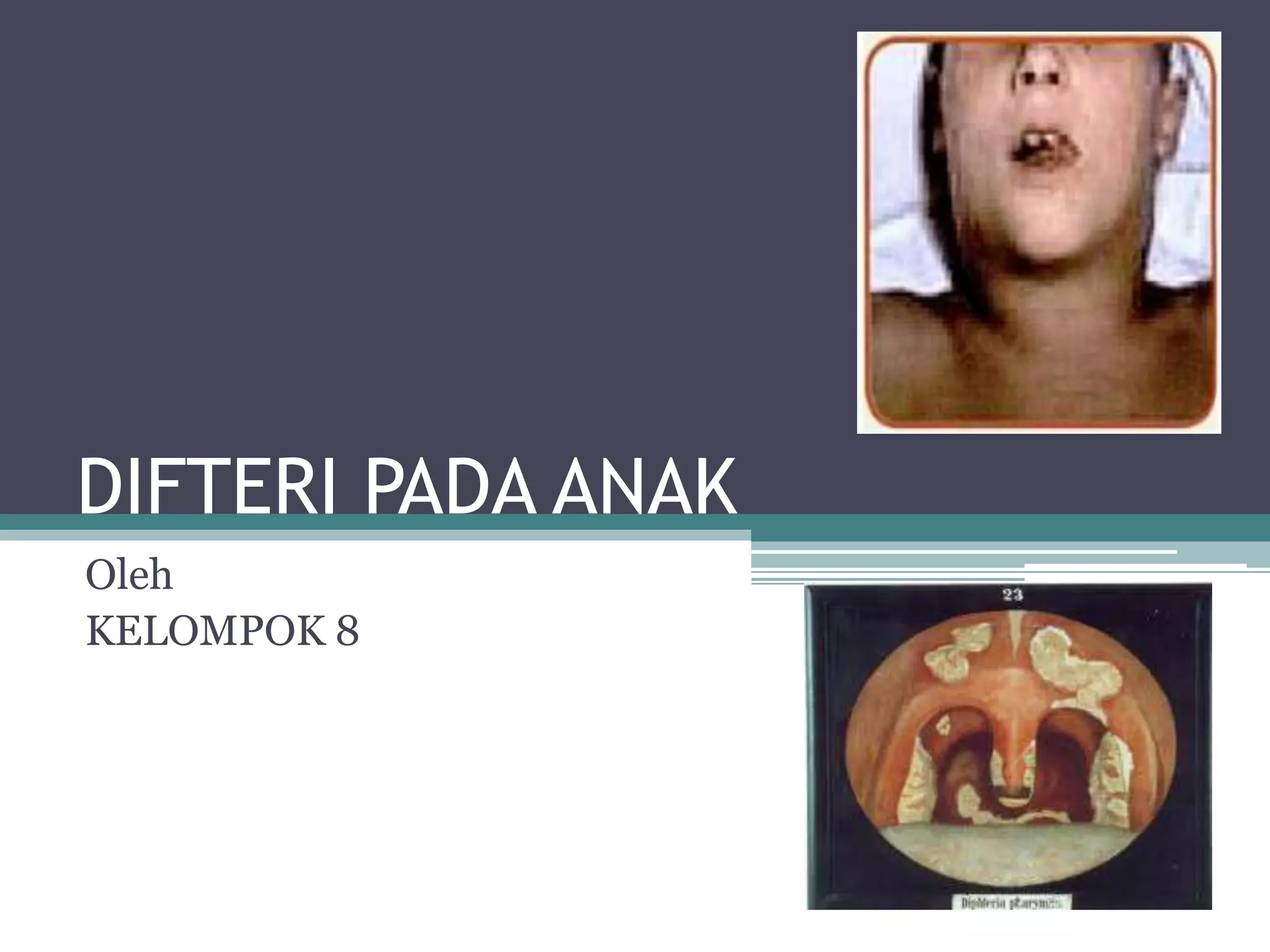 Difteri pada anak | PPTX