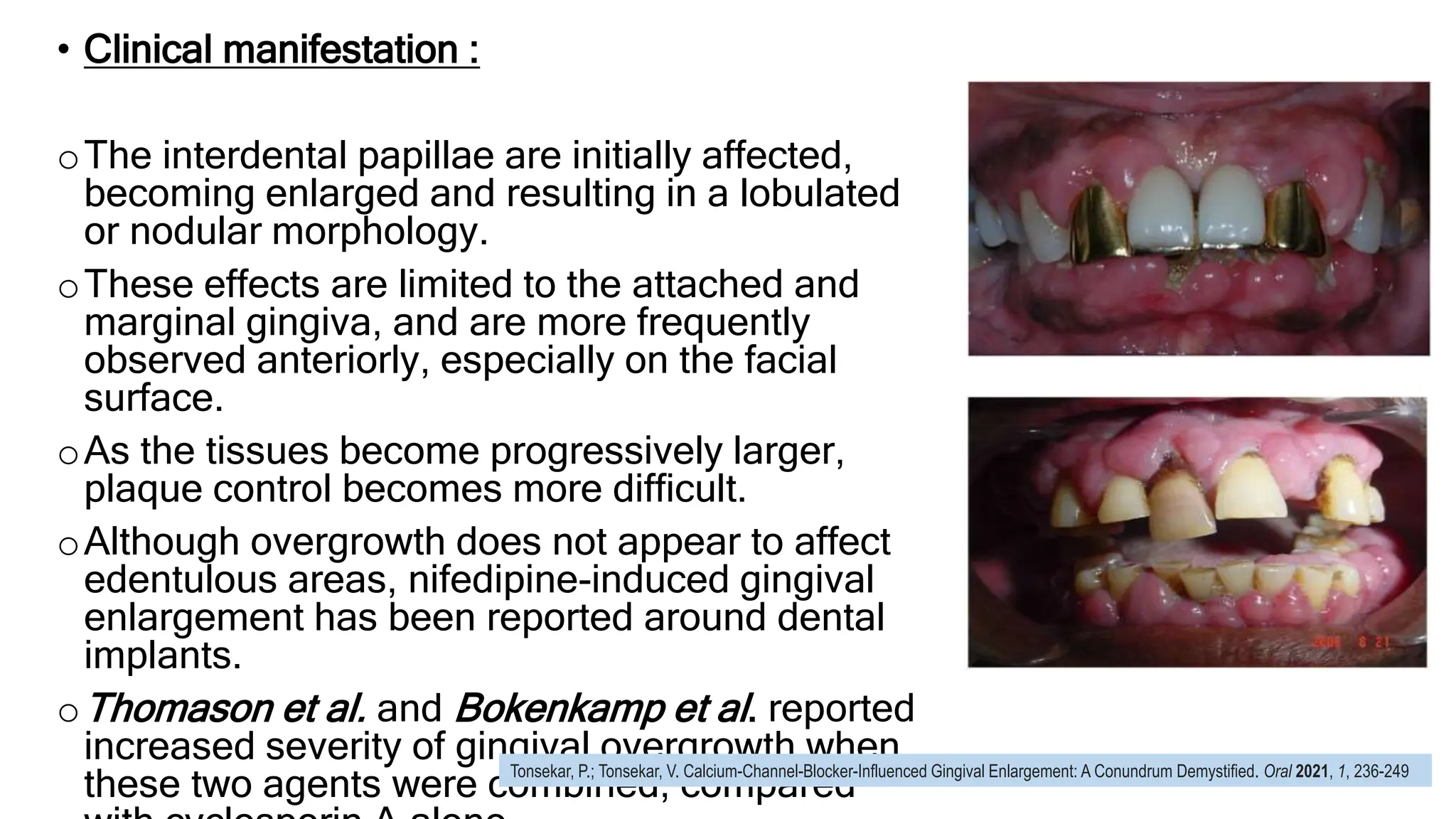 Drug induced gingival enlargement - DIGO | PPTX