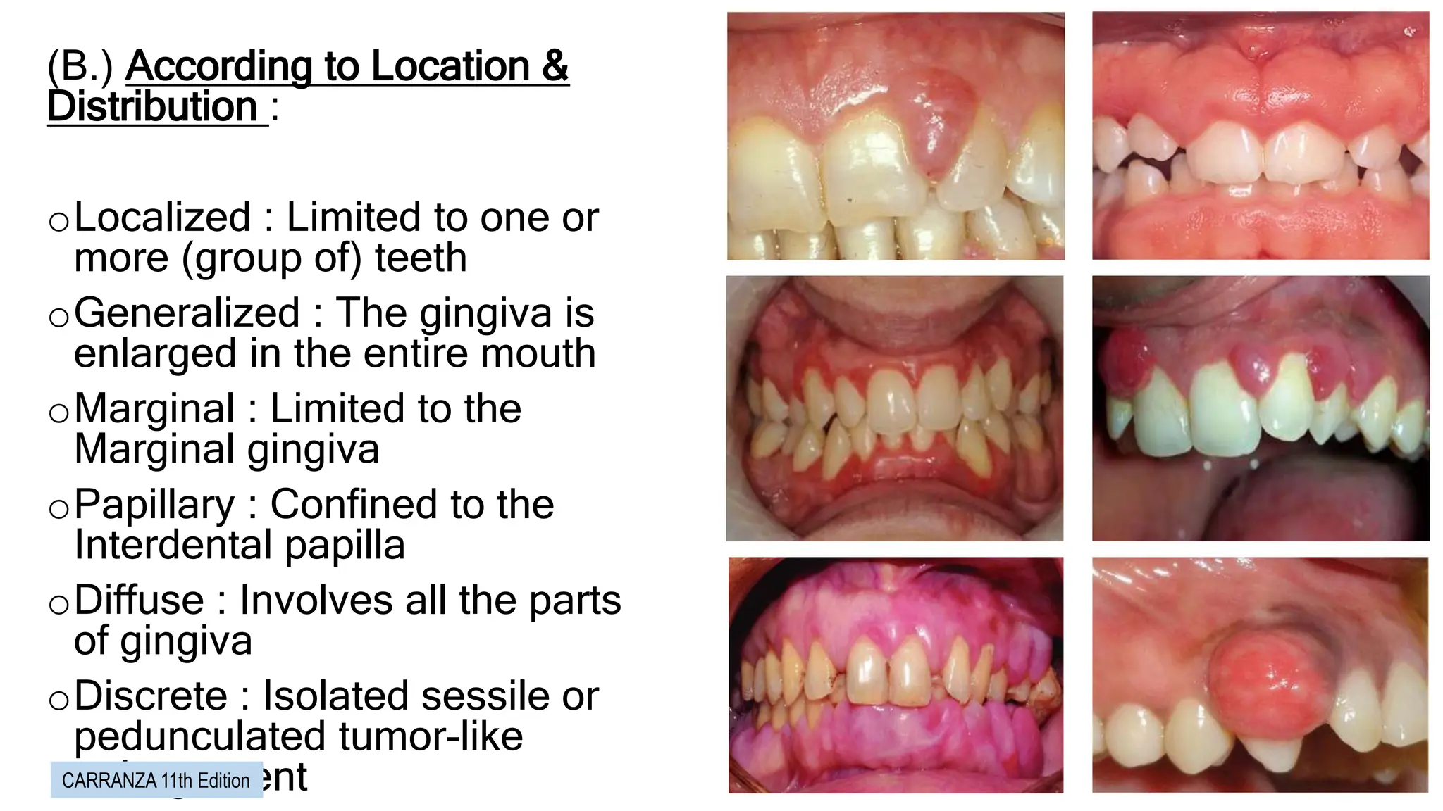 Drug induced gingival enlargement - DIGO | PPTX