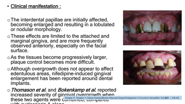 Drug induced gingival enlargement - DIGO | PPTX | Dental Health ...