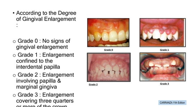 Drug induced gingival enlargement - DIGO | PPTX | Dental Health ...