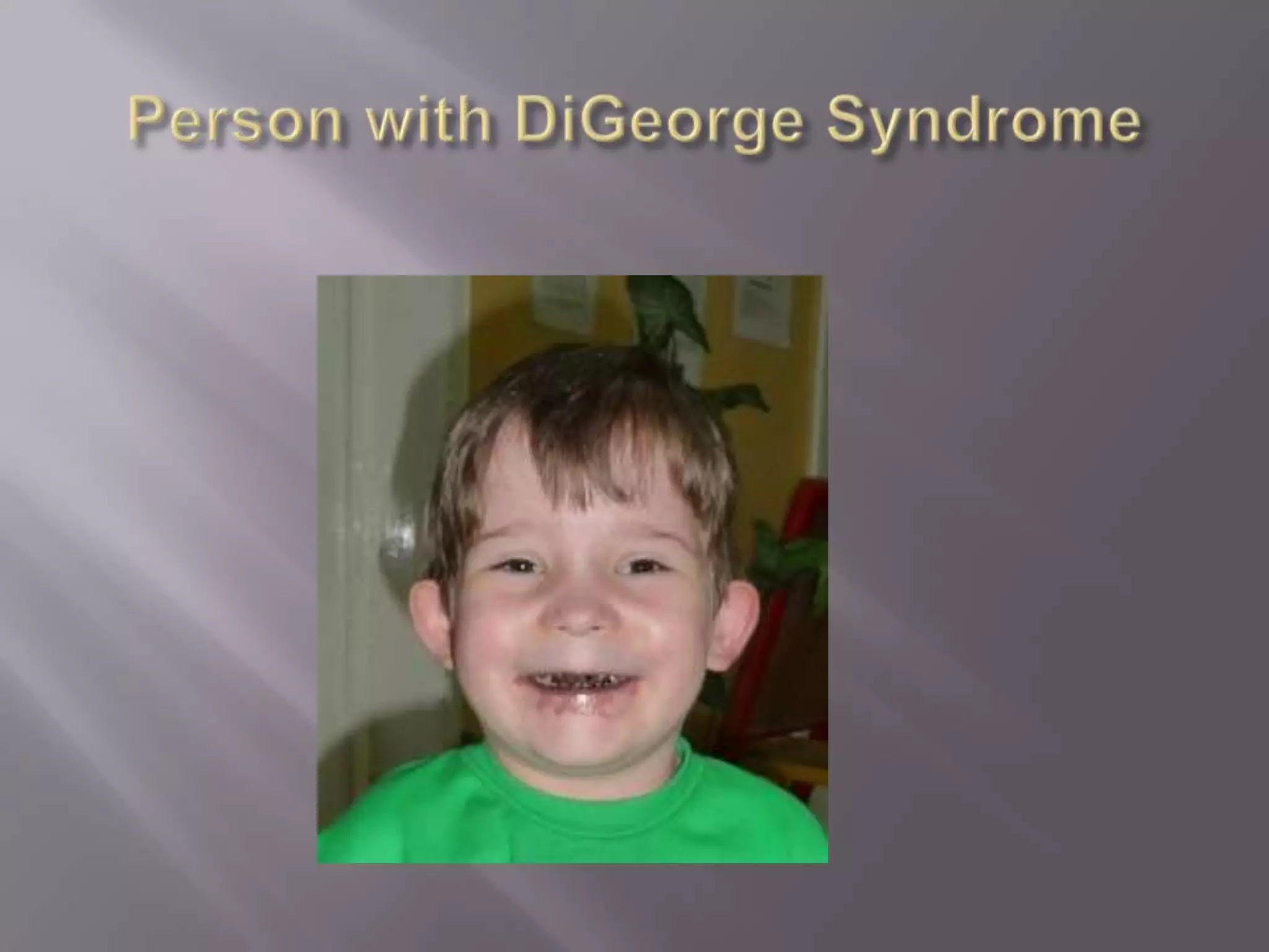 Di george syndrome | PPTX