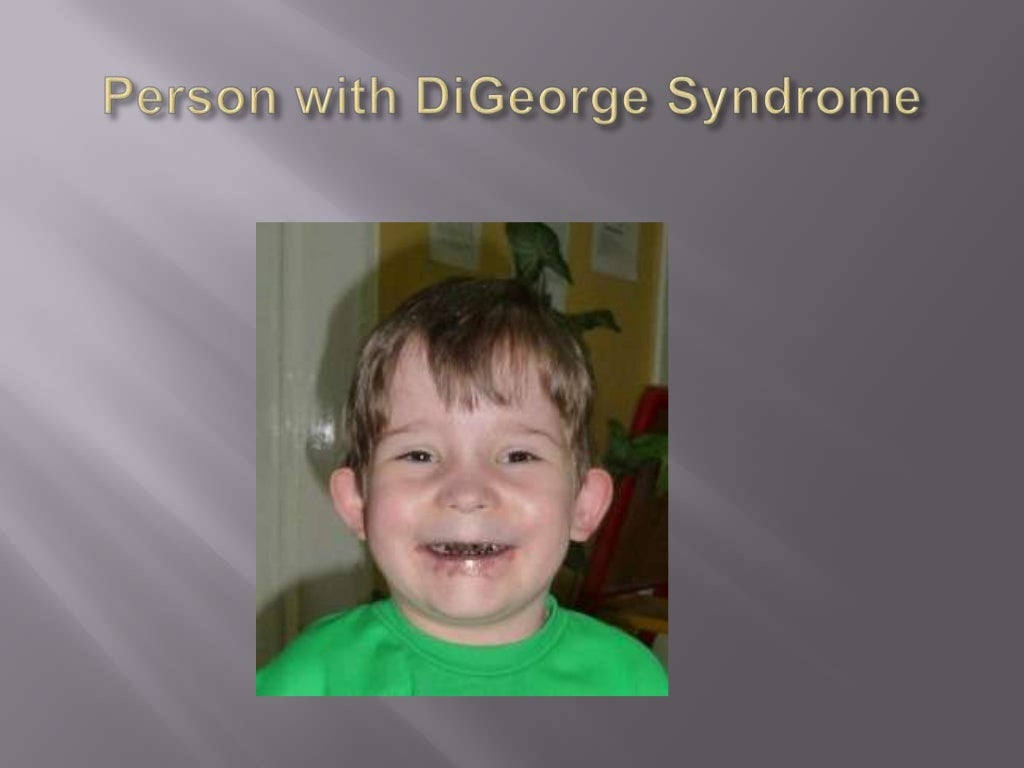 Di george syndrome