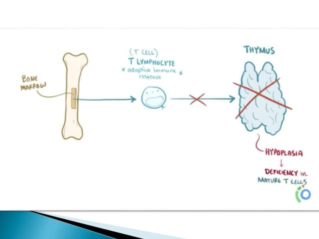 Digeorge syndrome | PPTX | Thyroid Disorders | Endocrine and Metabolic ...