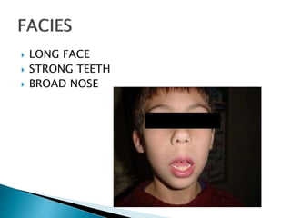 Digeorge Syndrome Facies