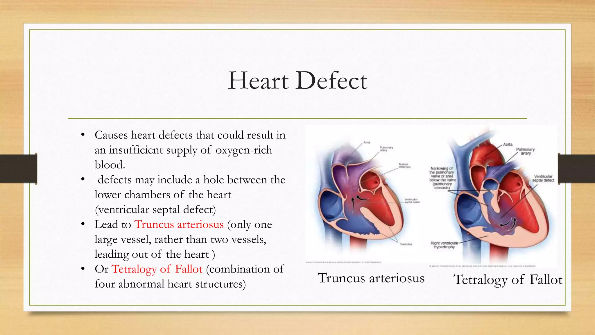 Digeorge syndrome | PPTX