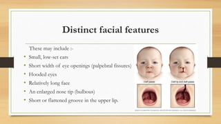 Digeorge Syndrome Facies