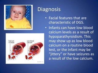 Di george syndrome (dgs) | PPTX | Blood Disorders | Diseases and Conditions