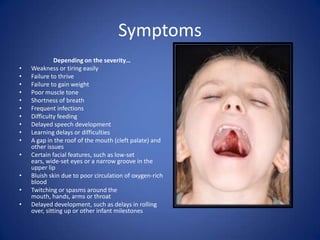 Digeorge Syndrome Facial Features