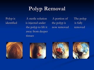 Colonoscopy, Hematochezia, Cachexia, Anastomosis | PPT