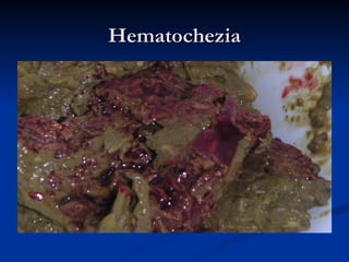 Colonoscopy, Hematochezia, Cachexia, Anastomosis | PPT