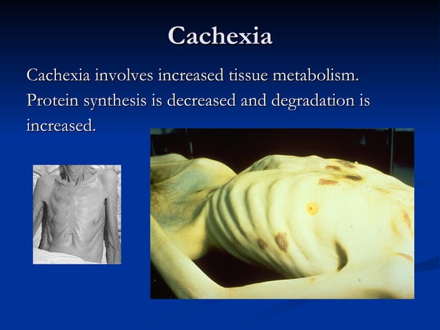Colonoscopy, Hematochezia, Cachexia, Anastomosis