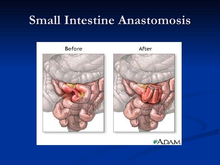 Colonoscopy, Hematochezia, Cachexia, Anastomosis
