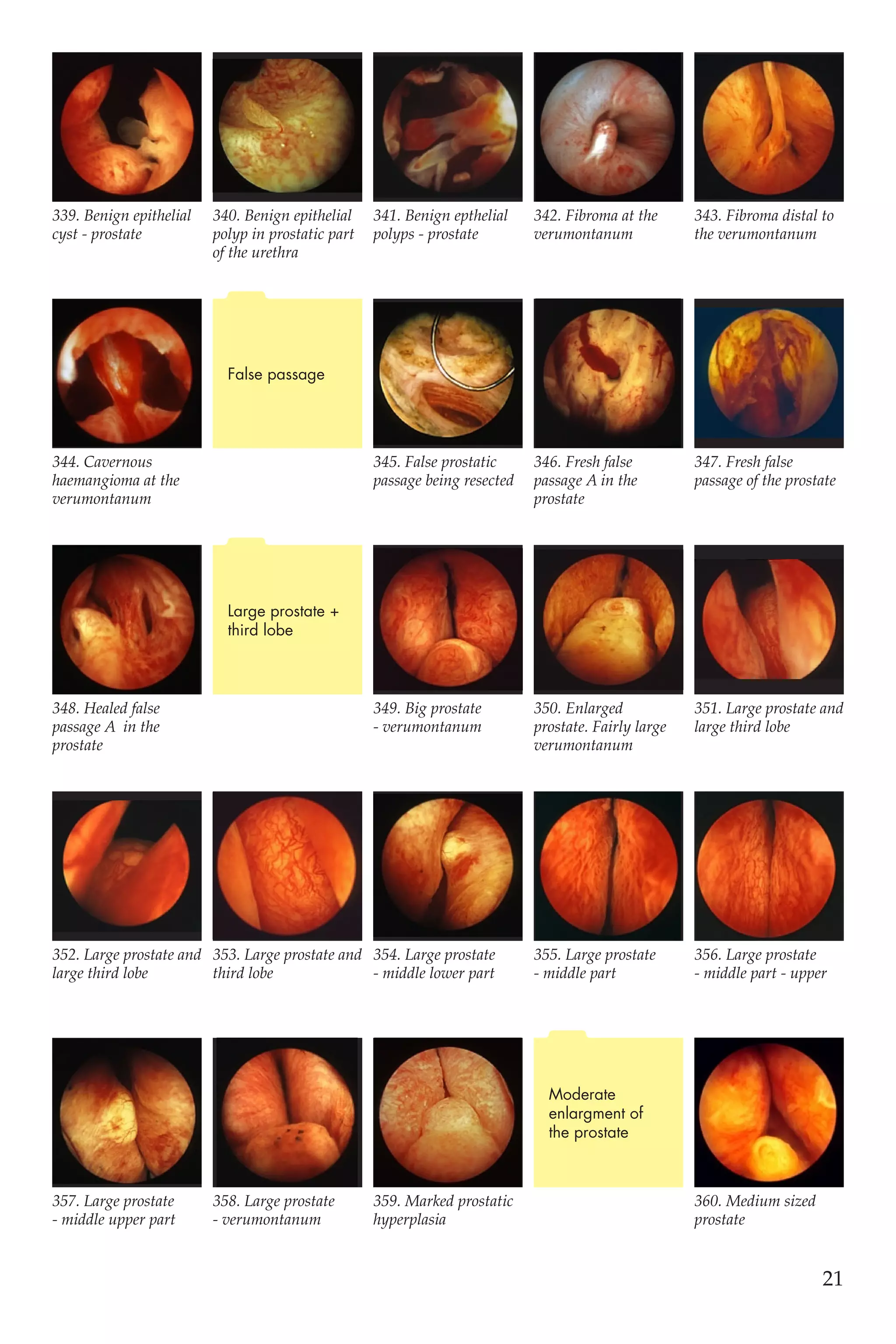 Digital atlas of cystoscopy.pdf