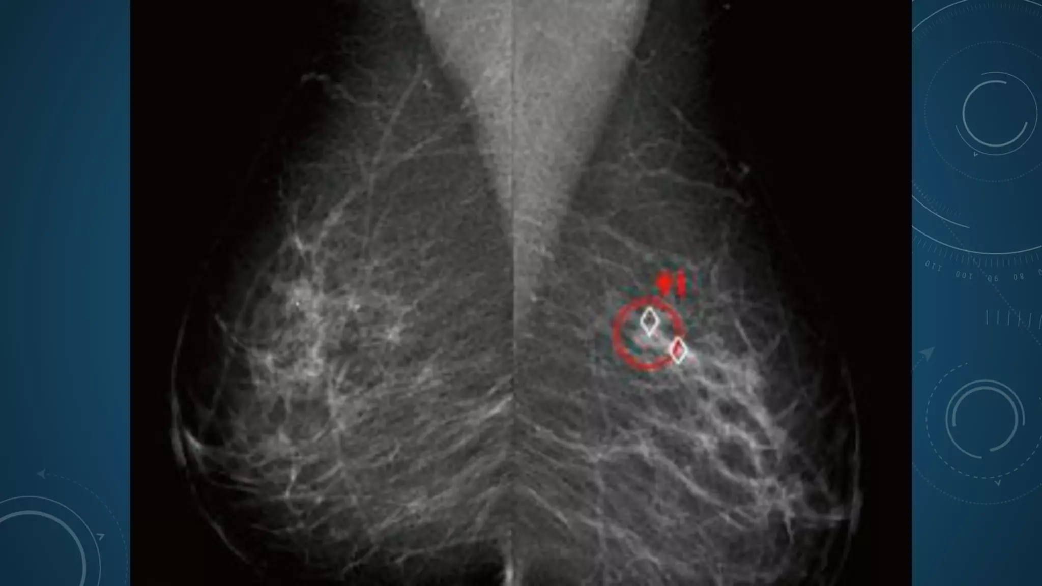 Digital breast tomosynthesis | PPTX