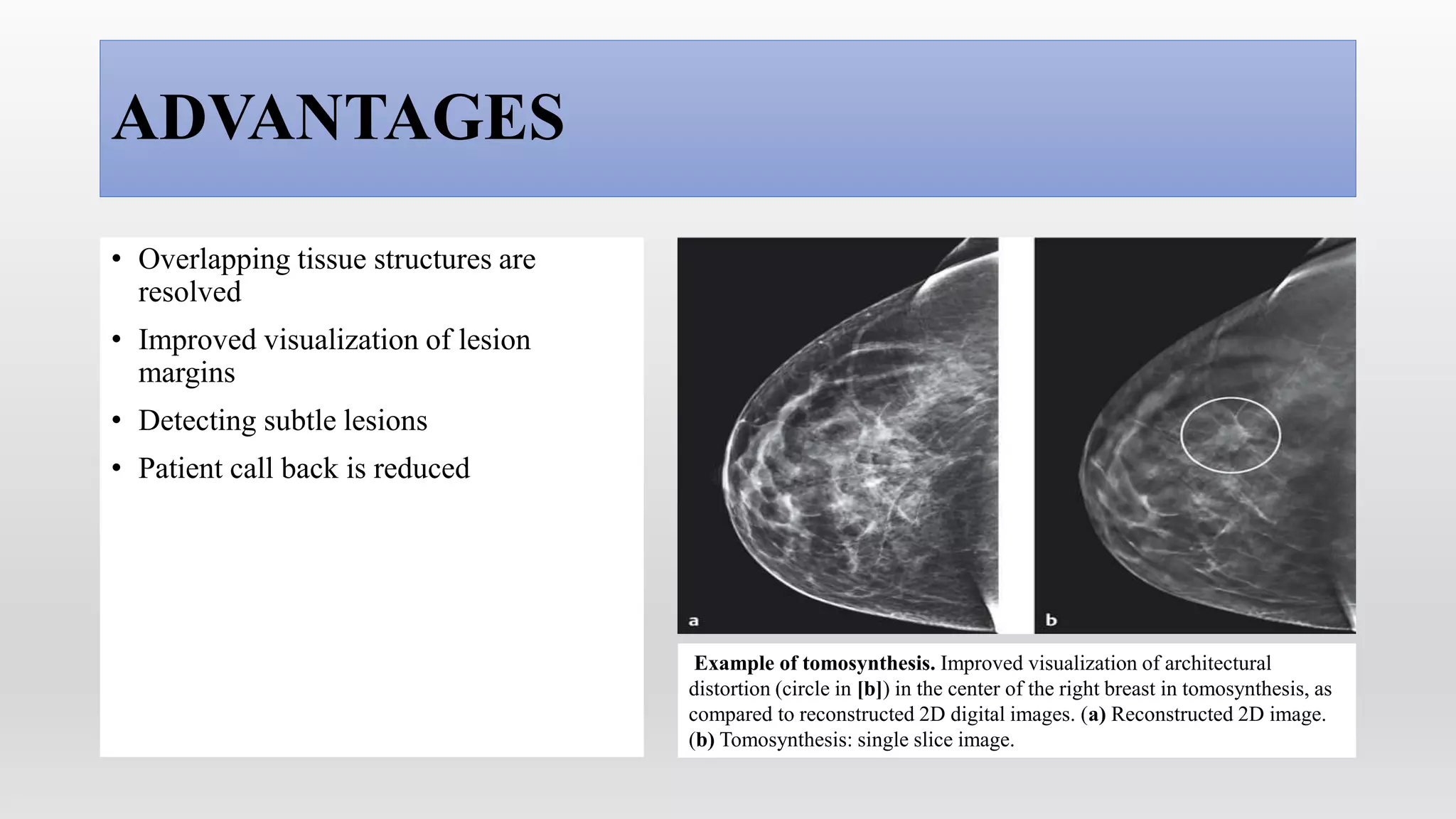 Digital breast tomosynthesis | PPTX