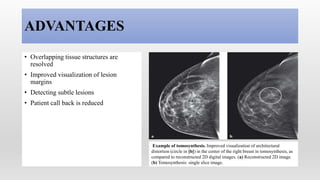 Digital breast tomosynthesis | PPTX