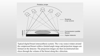 Digital breast tomosynthesis | PPTX