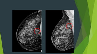 Digital Breast Tomosynthesis | PPTX